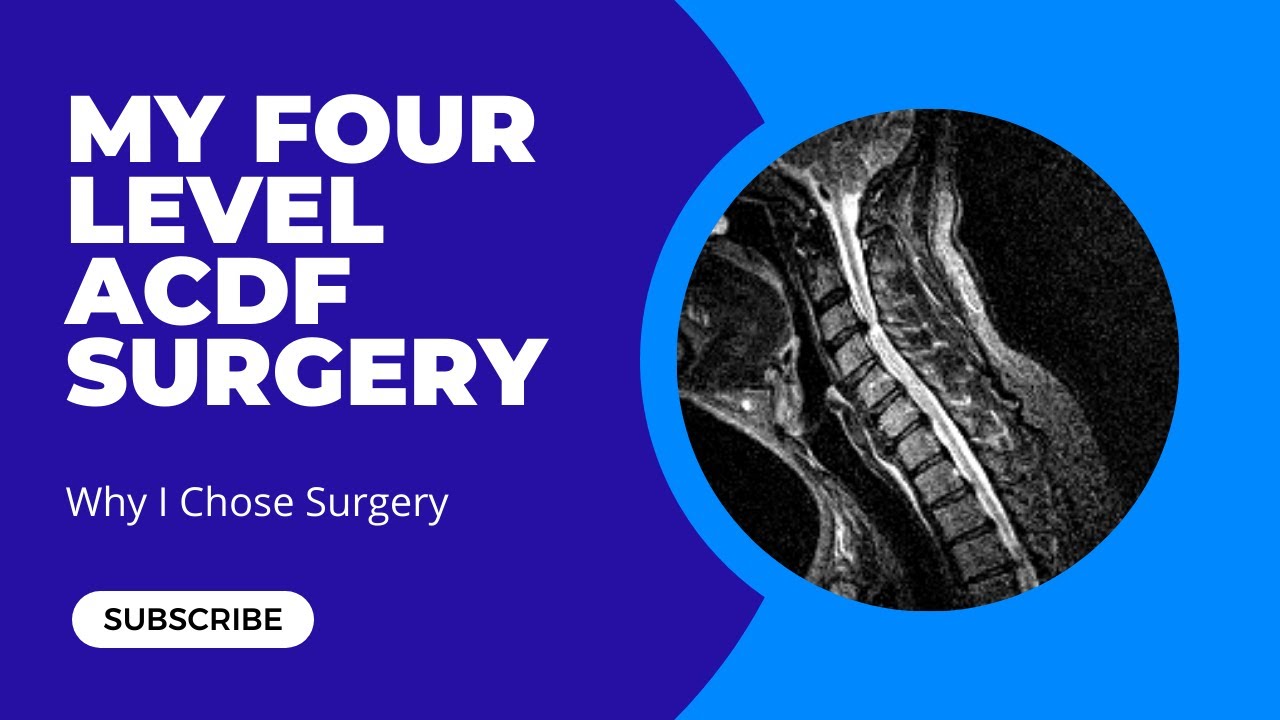 Four Level Fusion ACDF C3-C7: How I chose my surgeon and surgery - YouTube