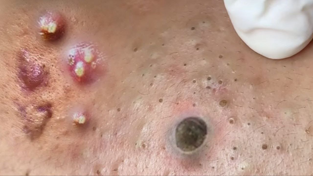 Blackhead removal | Natural acne treatments | 𝐂𝐫𝐚𝐳𝐲 𝐒𝐚𝐭𝐢𝐬𝐟𝐲𝐢𝐧𝐠 ...