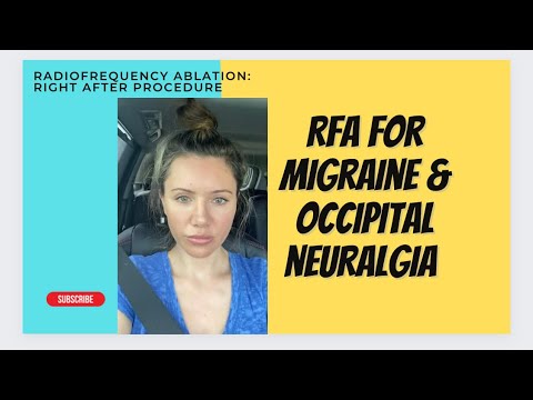 My experience 1st RFA radiofrequency ablation for migraine & occipital ...