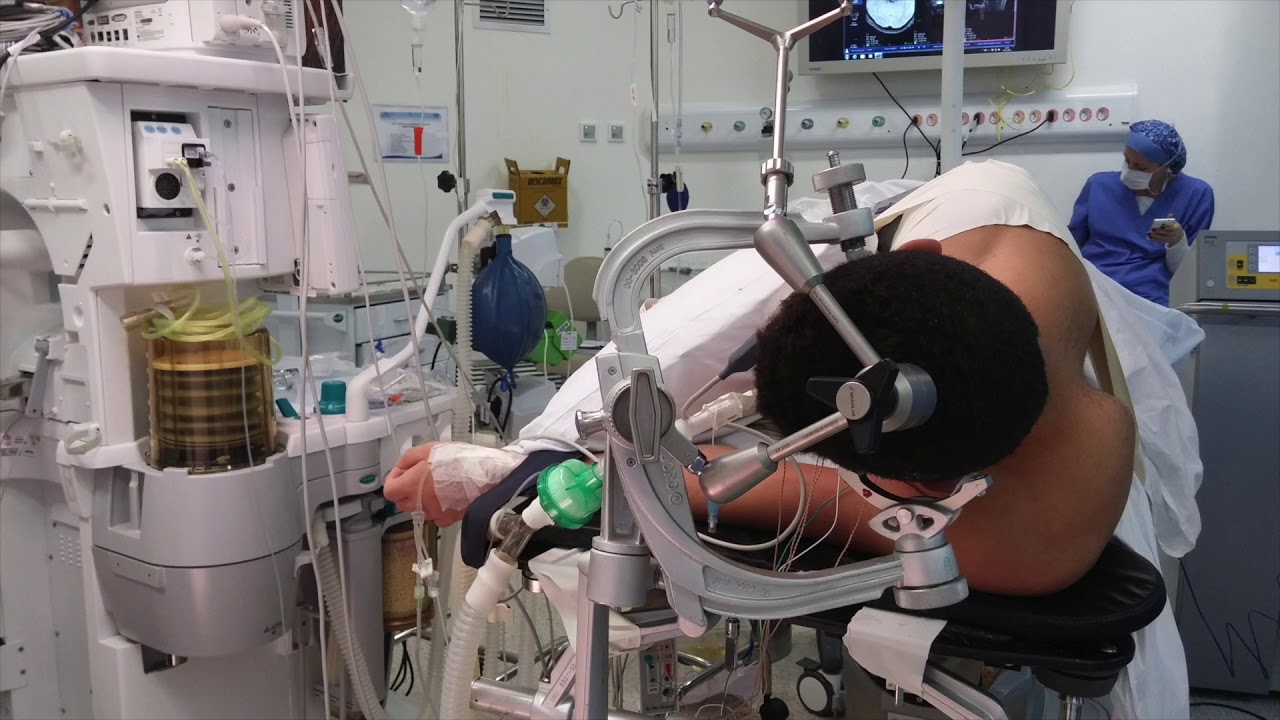 Median suboccipital craniotomy and telovelar approach for posterior ...