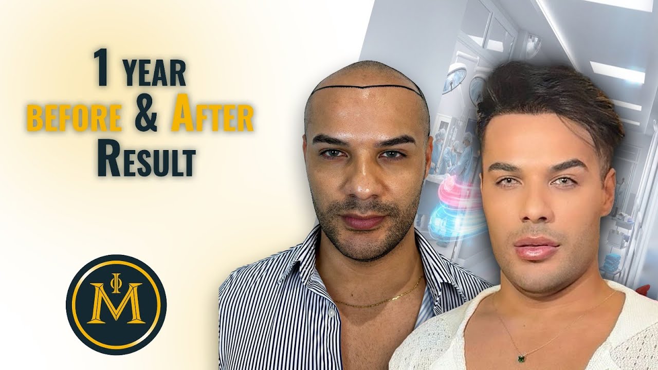 1 Year Before and After Hair Transplantation Result! - YouTube