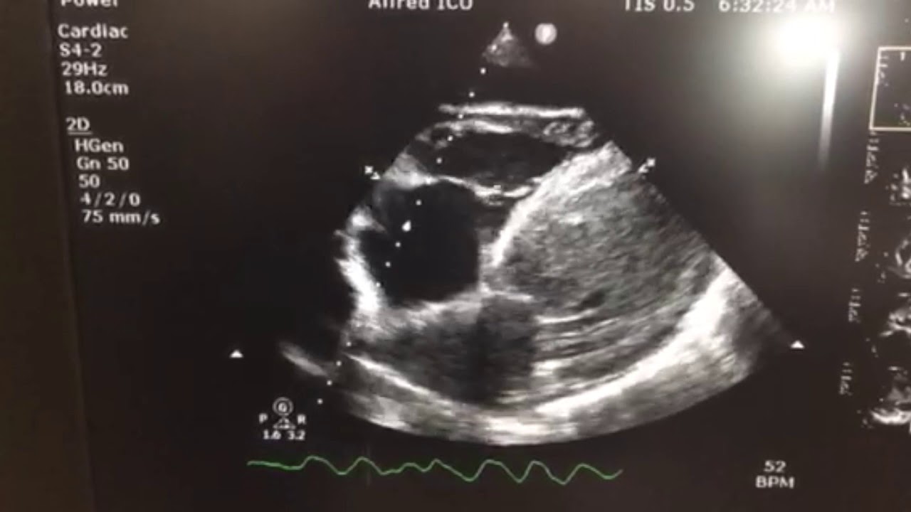 Left ventricular thrombus - YouTube