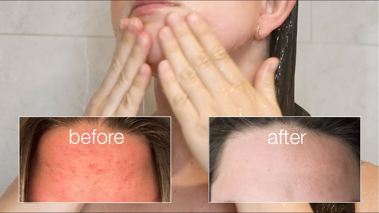 Beating Acne Again?! My Best Skin Ever - YouTube