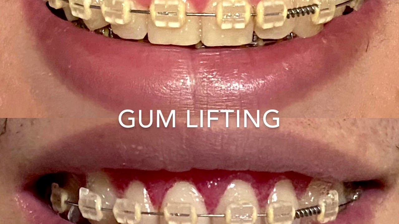 GUM LIFTING procedure to myself - YouTube
