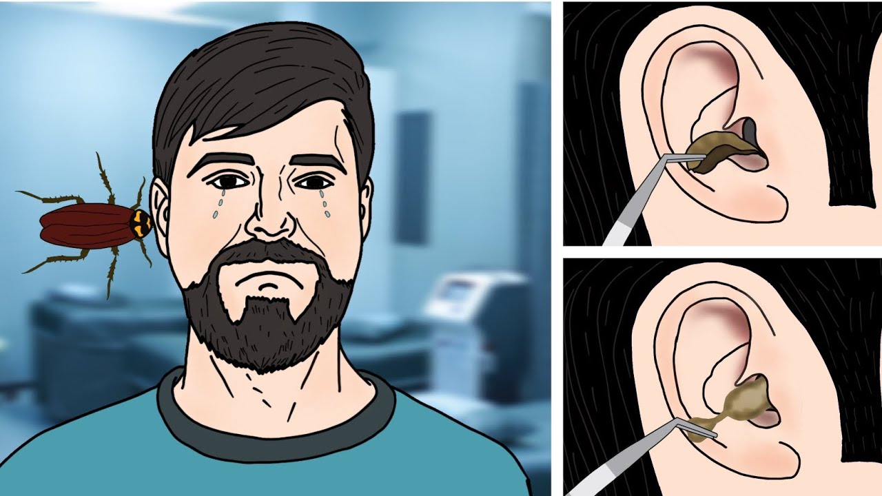 [ASMR ANIMATION] Remove💎 cockroach in MrBeast's ear | Asmr Help MrBeast ...