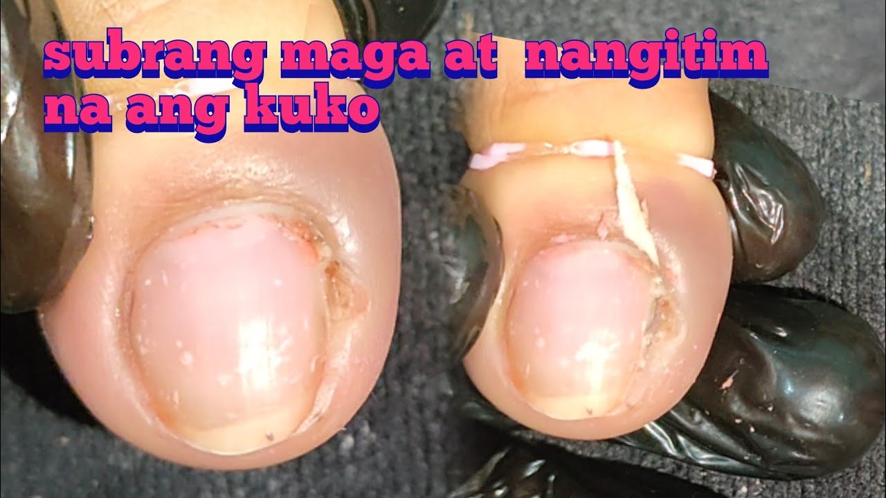 namumula at nangingitim sa subrang maga ang kuko. Firstm ni ate na ...