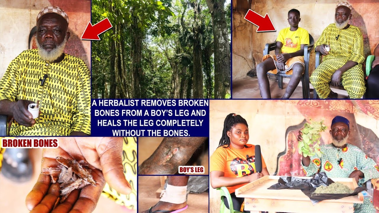 Herbalist Removed Broken Bones From A Boy's Leg And Heals The Leg ...