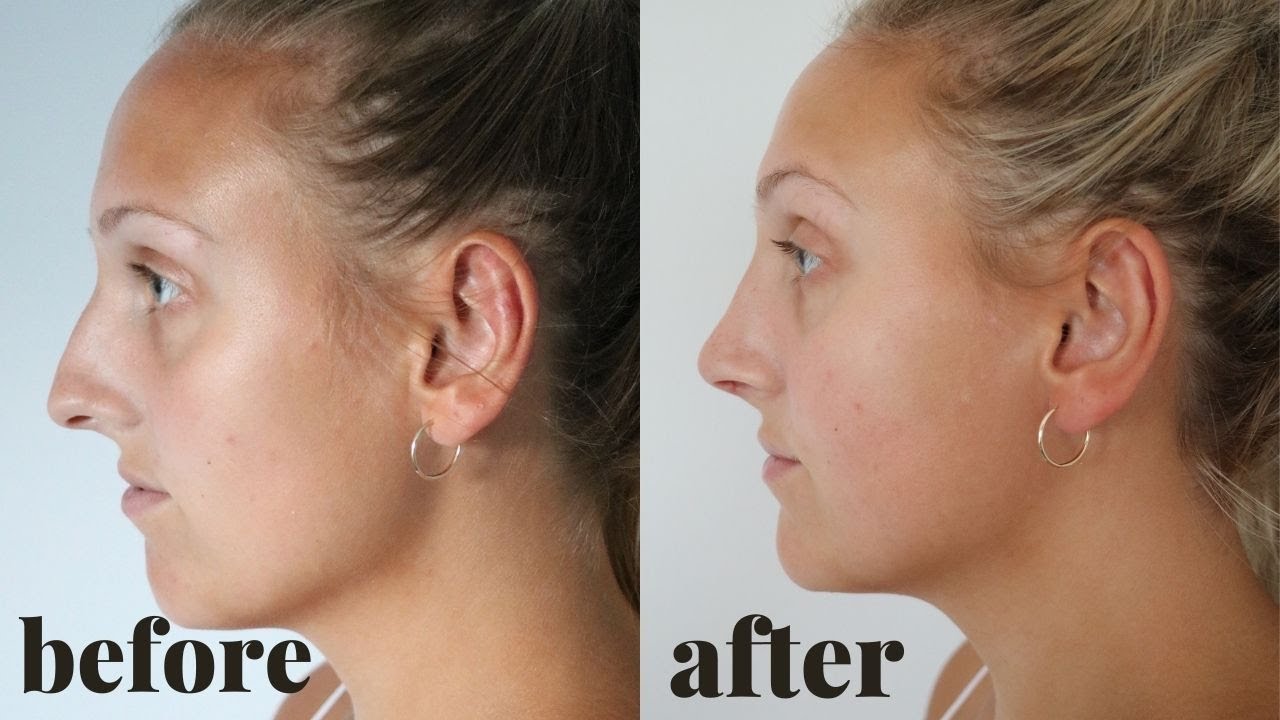 MY NOSE JOB REVEAL | cast removal + before and after!! - YouTube