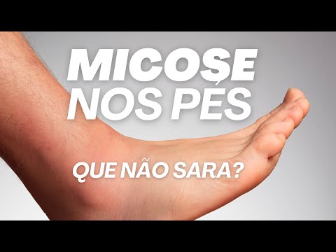 Micose nos pés que não sara? Por Dr. Luiz Gameiro, dermatologista