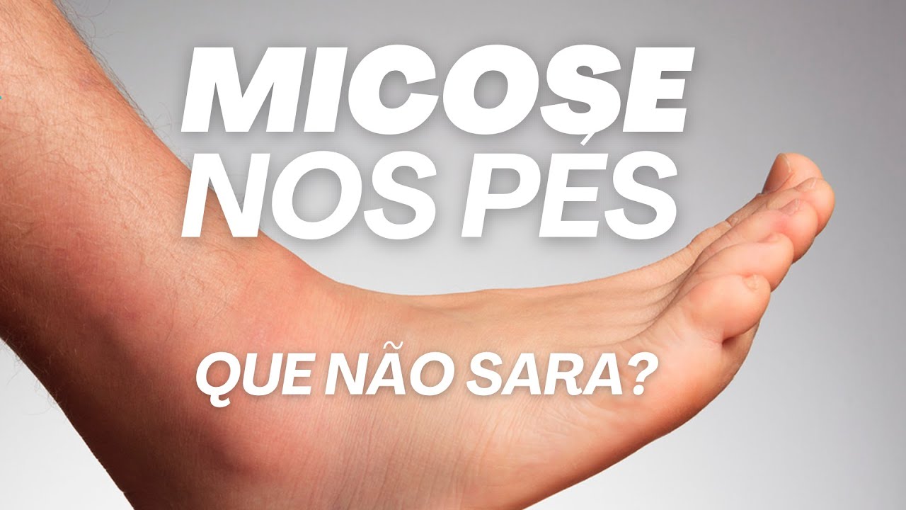 Micose nos pés que não sara? Por Dr. Luiz Gameiro, dermatologista - YouTube