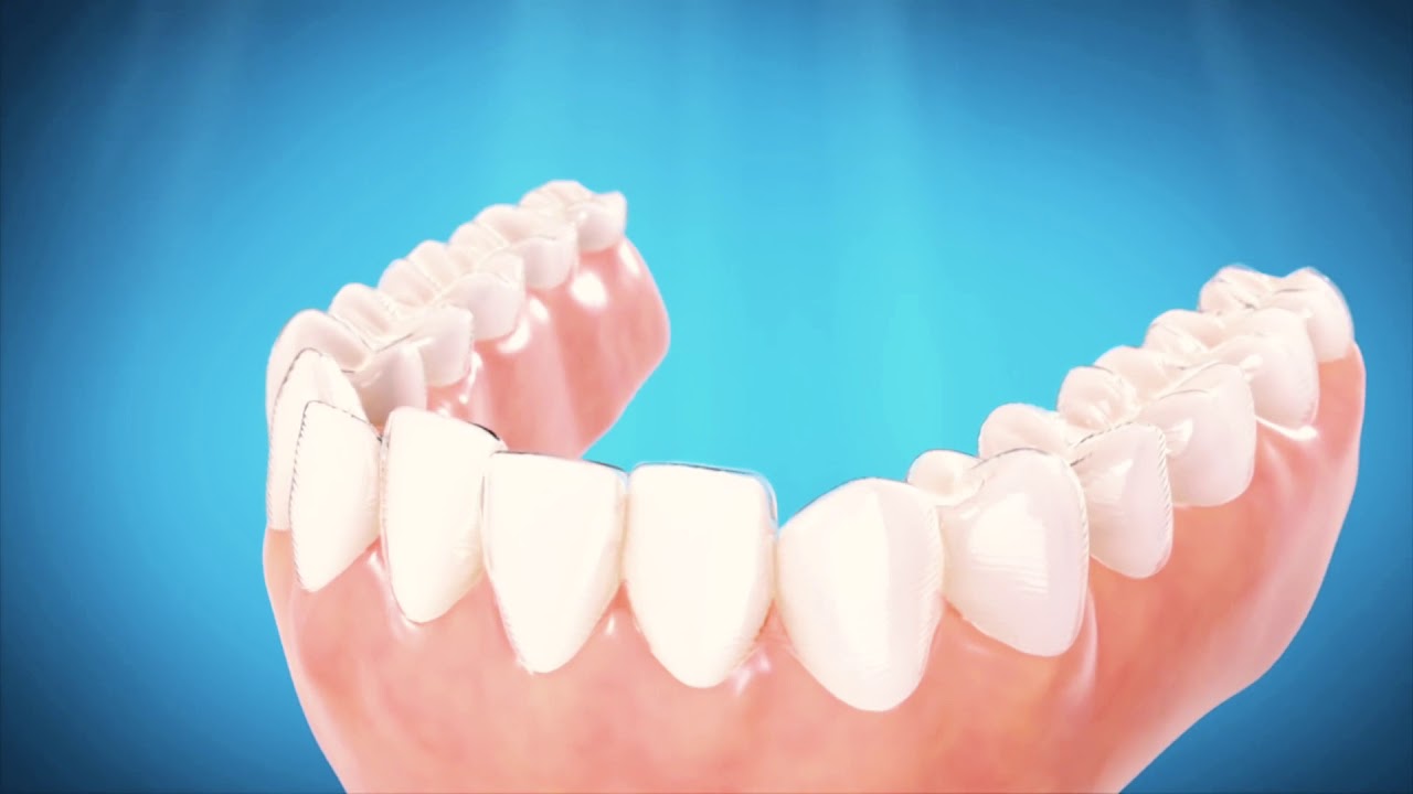 Invisalign Open Day Promo FINAL - YouTube