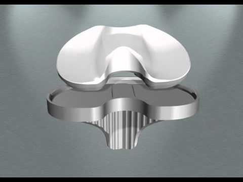 Tibial Insert Baseplate Fitment - YouTube