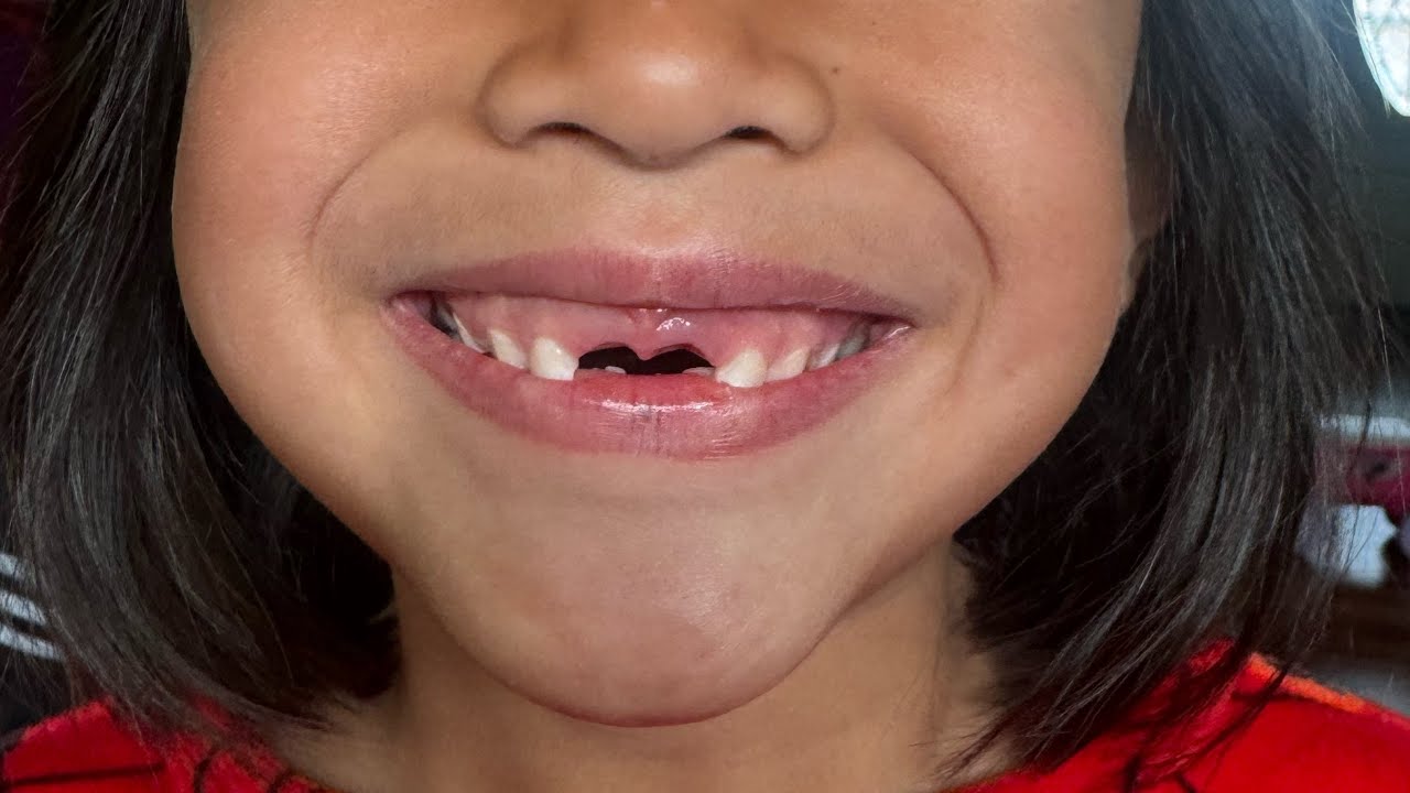 Tooth pull with the door - YouTube