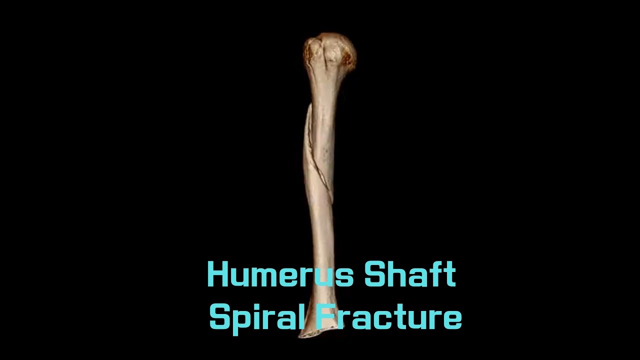 Humerus shaft spiral fracture - YouTube