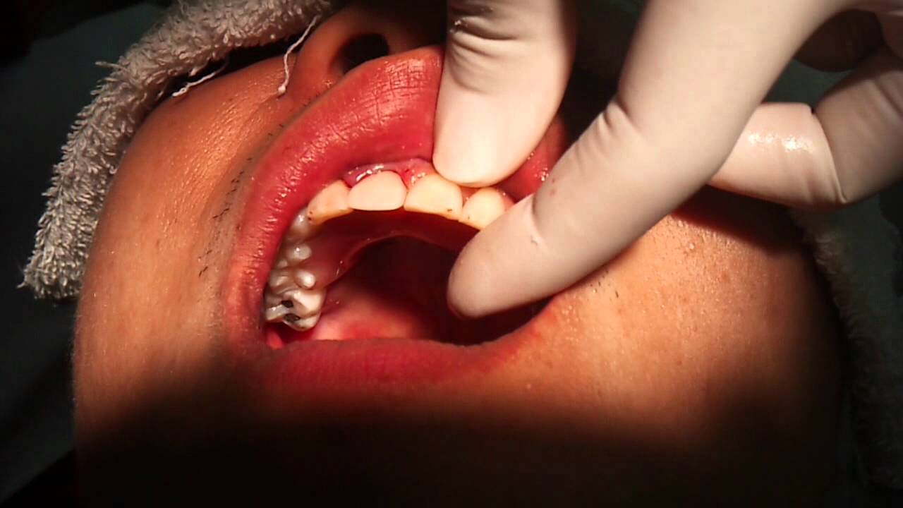 Dental Bangkok Pruksa: Extraction of front tooth Part II - YouTube