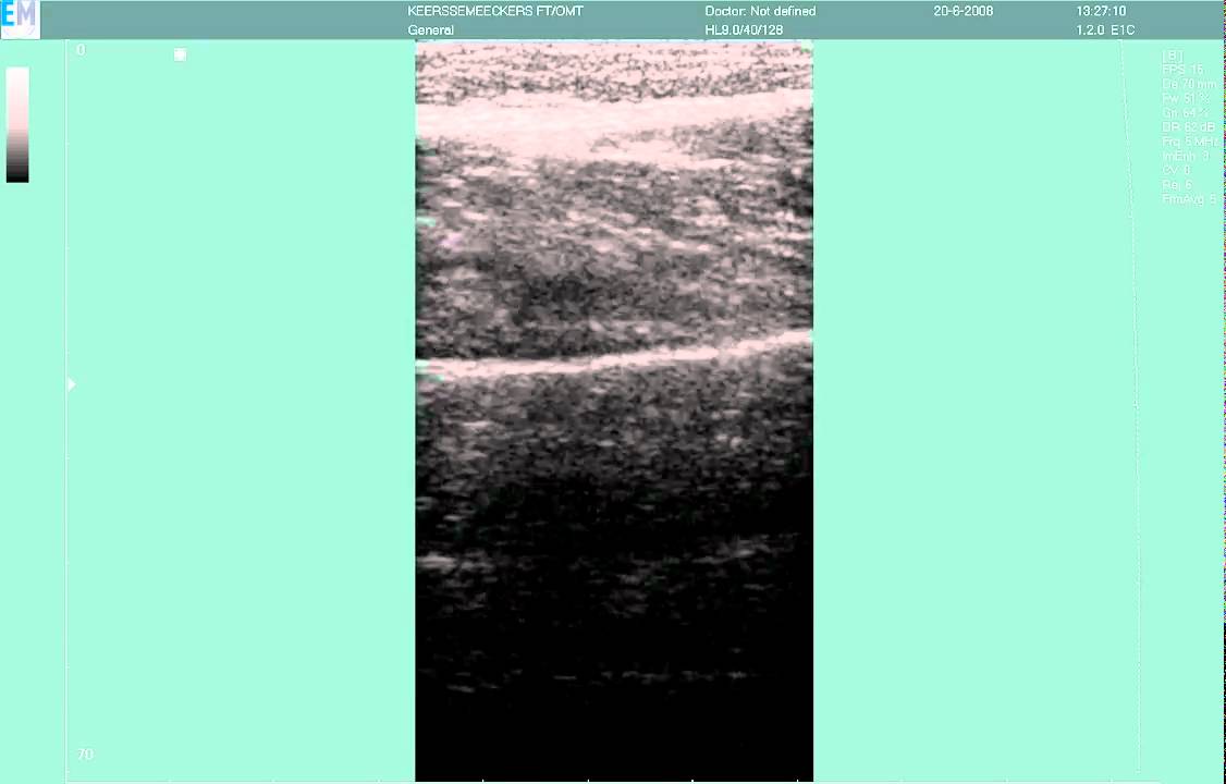 dry needling - gastrocnemius - echo - local twitch response.avi - YouTube