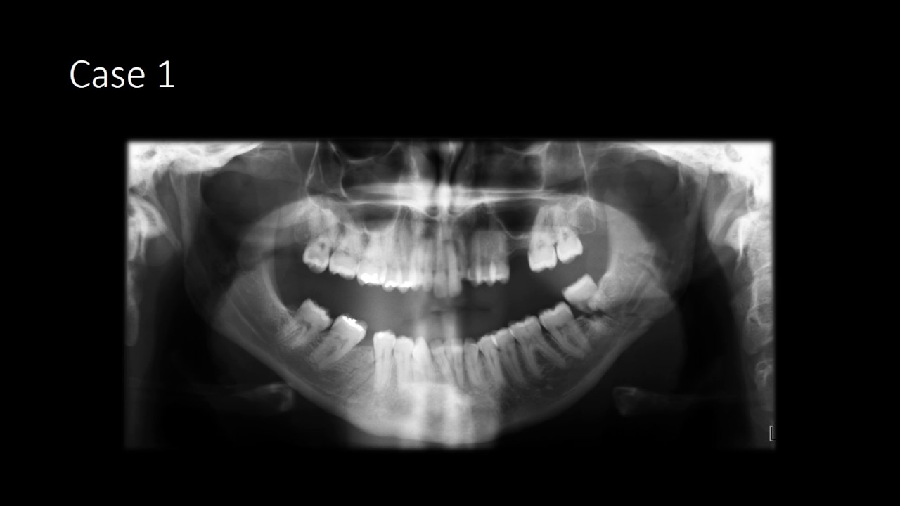 Mandible Fractures on Panoramic Radiographs - YouTube