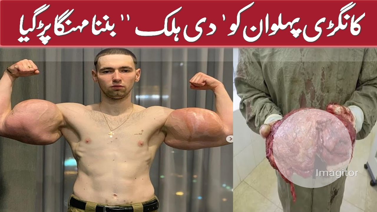Russian Body Builder Inject Petroleum Jelly In His Arms | Nouman Time ...