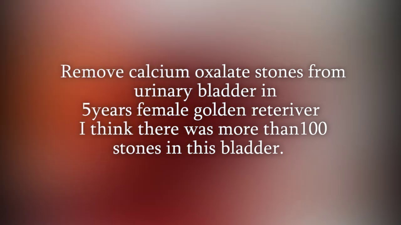 Removal of calcium oxalate stones from urinary bladder in 5 years ...