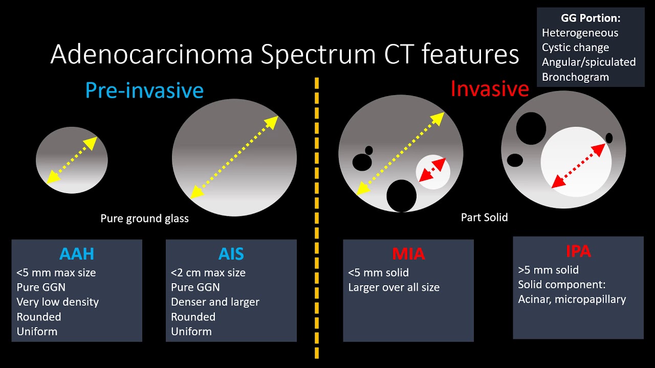 Adenocarcinoma Spectrum - YouTube