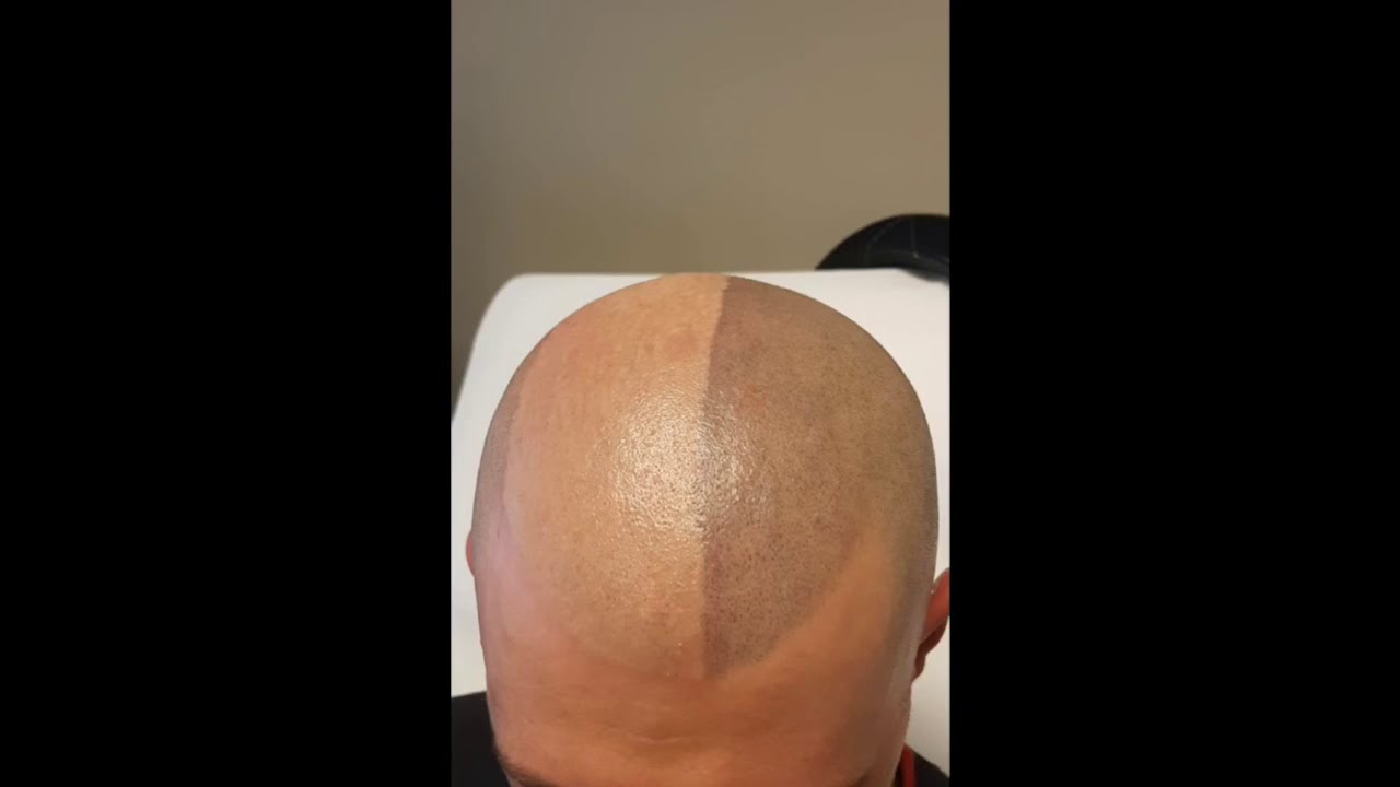 Scalp Micropigmentation Gone Wrong and How to FIX - YouTube