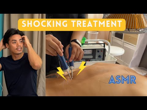 Relaxing Acupuncture and Fire Cupping to Release Chi Blockage ASMR | Acuholistic