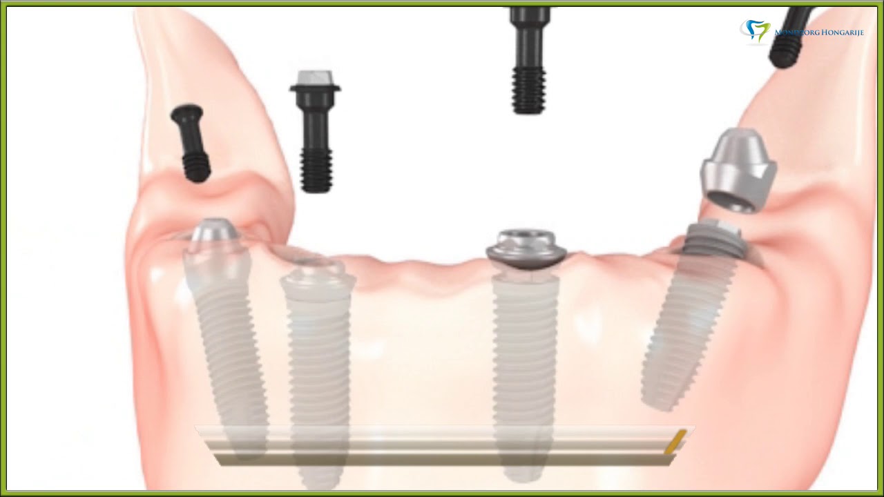All on 4. Vaste prothese op implantaten. - YouTube