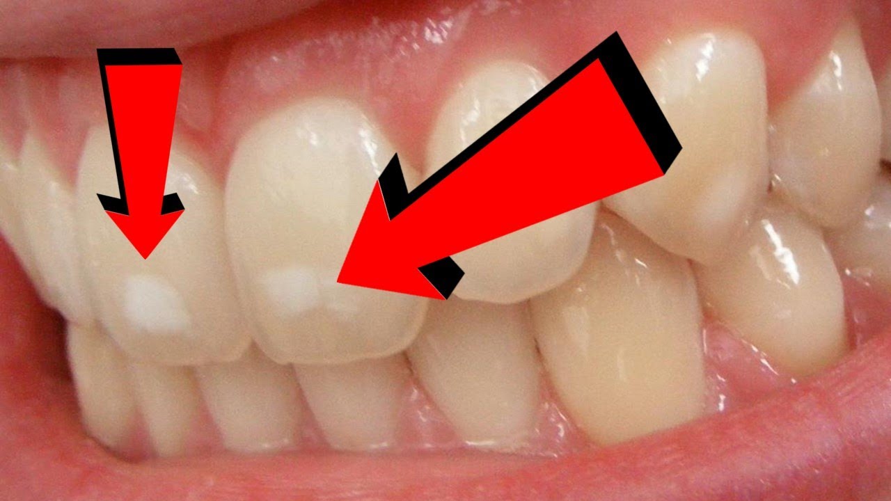 What Causes White Spots On Teeth How To Cure It Home Remedies YouTube what-causes-white-spots-on-teeth-how-to-cure-it-home-remedies-youtube