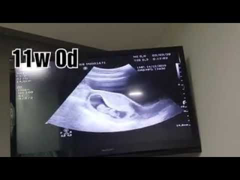 Usg kehamilan 11 minggu - YouTube