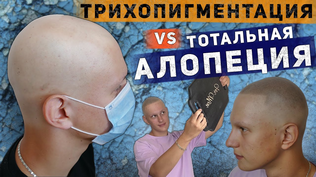 Трихопигментация vs Тотальная алопеция. Scalp micropigmentation by Andrey Afanasev - YouTube