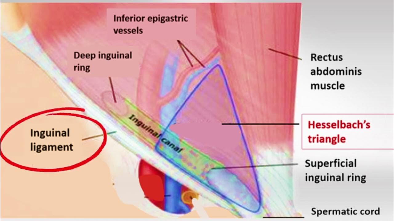 Borders of Hesselbach's Triangle Inguinal Hernia Direct vs Indirect - YouTube