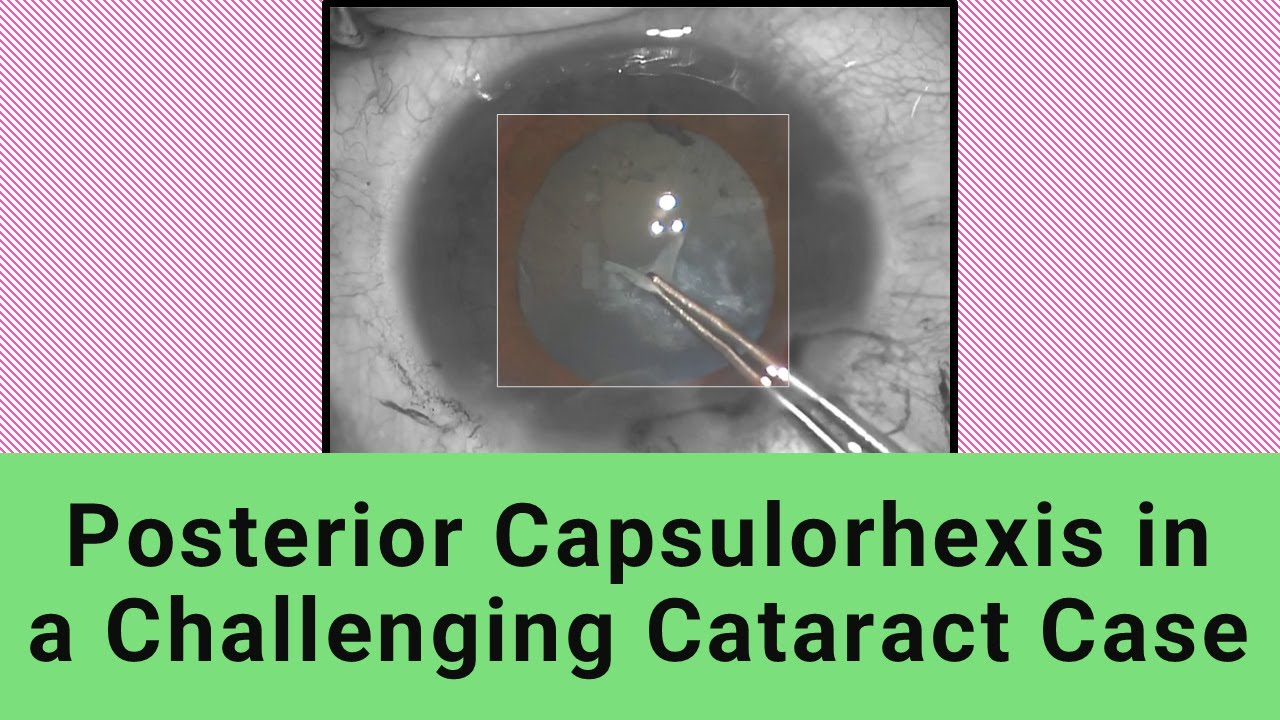 V210 Posterior Capsulorhexis in a Challenging Cataract Case - YouTube