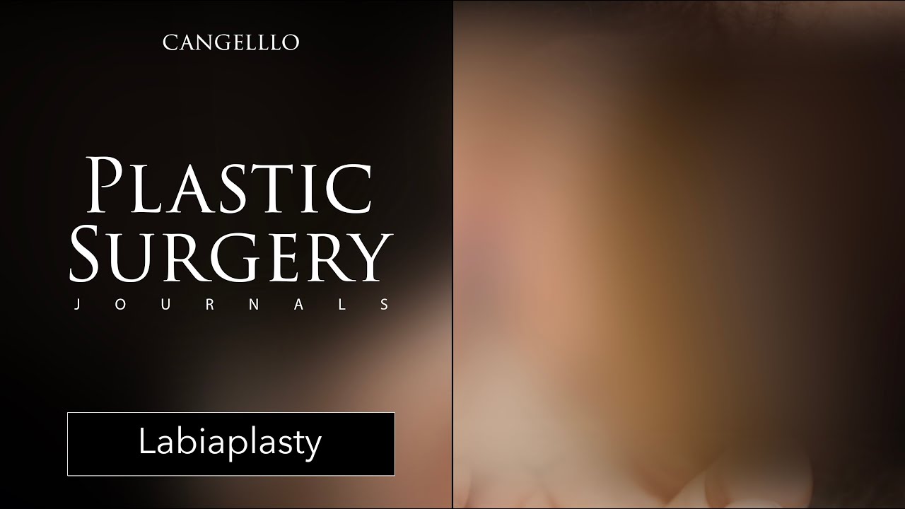 Labiaplasty Surgery | Plastic Surgery Journals | Cangello Plastic ...