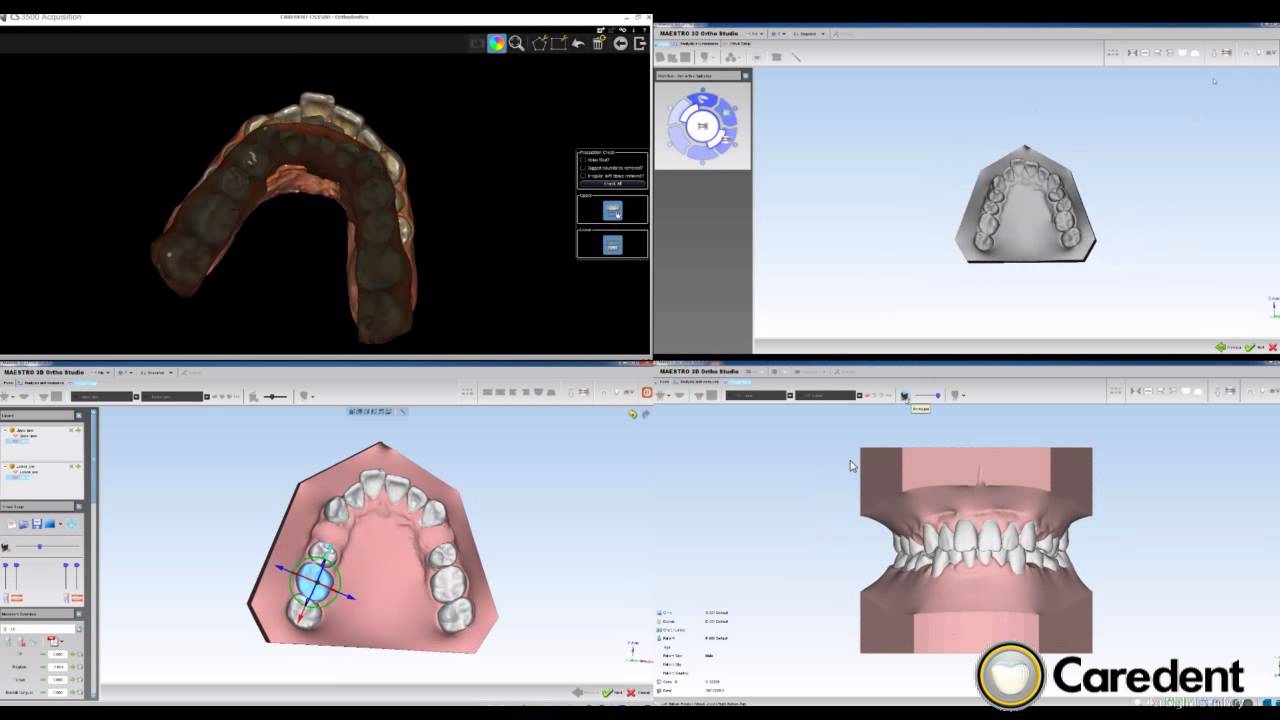 CS CAD Ortho uses of Carestream CS3500 Intraoral scanner - YouTube