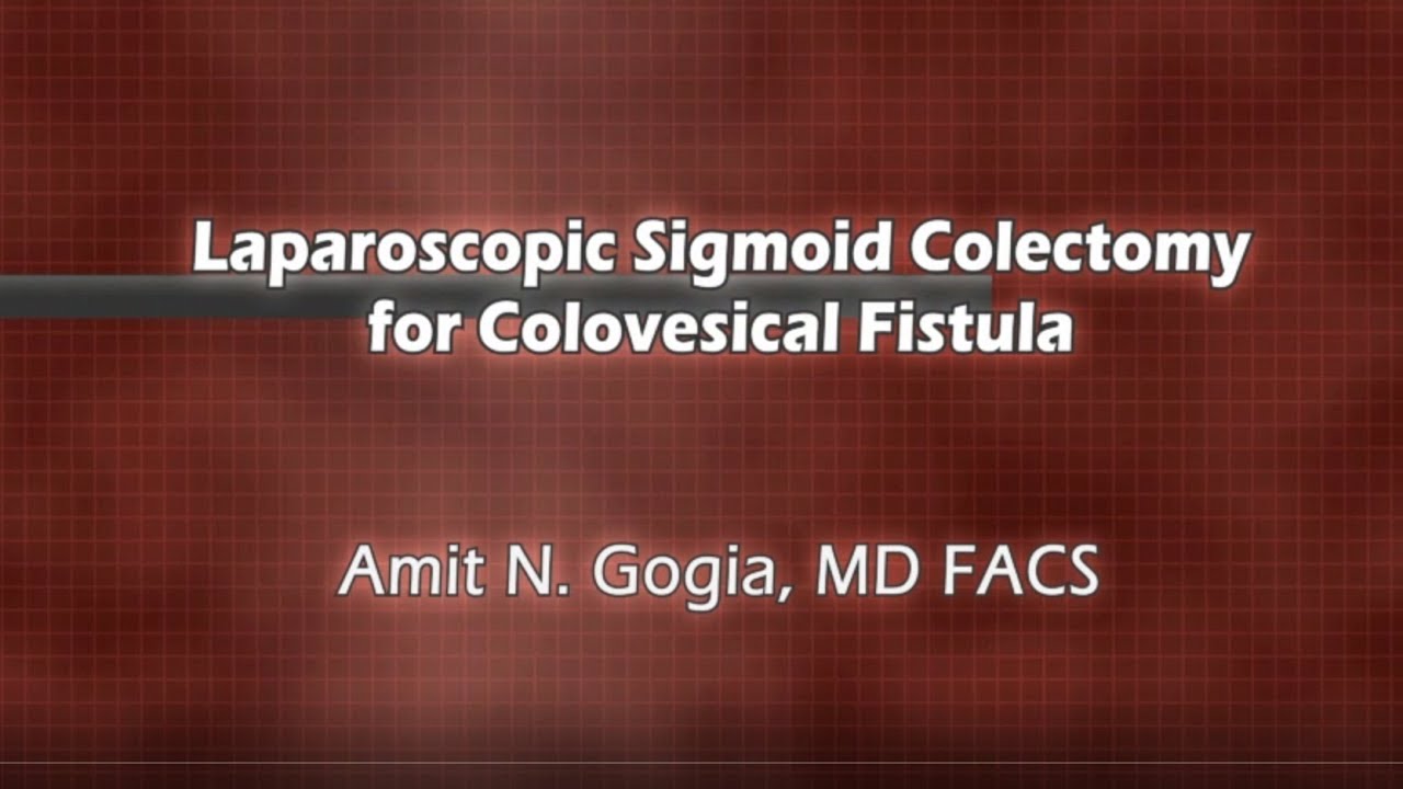 Laparoscopic Sigmoid Colectomy for Colovesical Fistula - YouTube