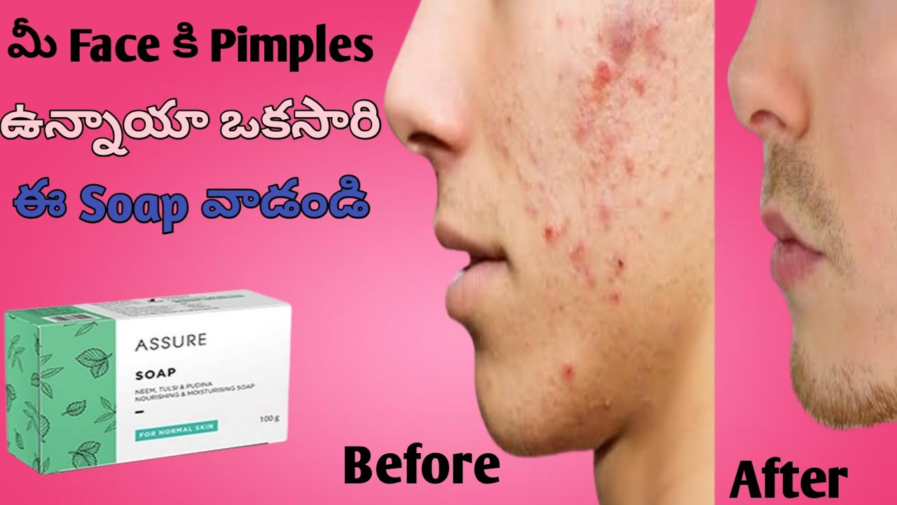 vestige assure soap benefits - YouTube