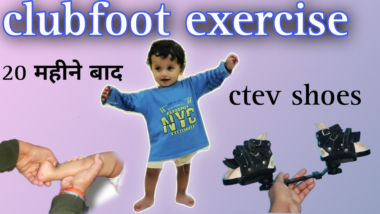 clubfoot exercise | ctev shoes | after 20 month - YouTube