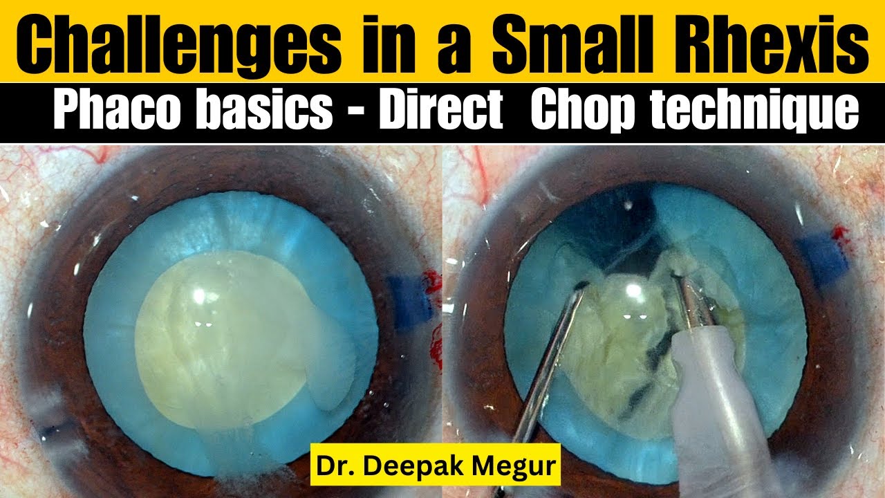Phaco basics - Direct chop challenges in a small rhexis - Dr. Deepak ...