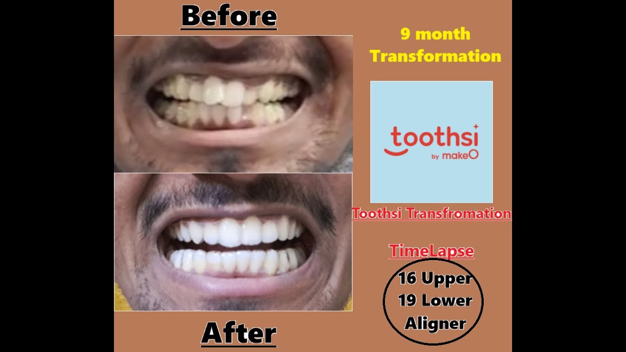 Toothsi Transformation (Timelapse) || 16 Upper Aligner || 19 Lower ...