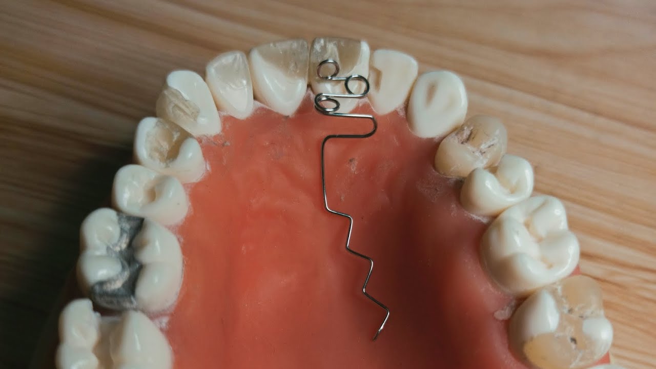 Orthodontic ((Z - spring)) - YouTube