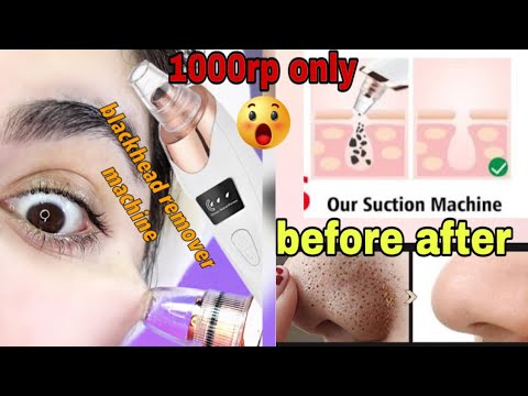 blackheads removing machine reviews | how to remove blackheads | - YouTube
