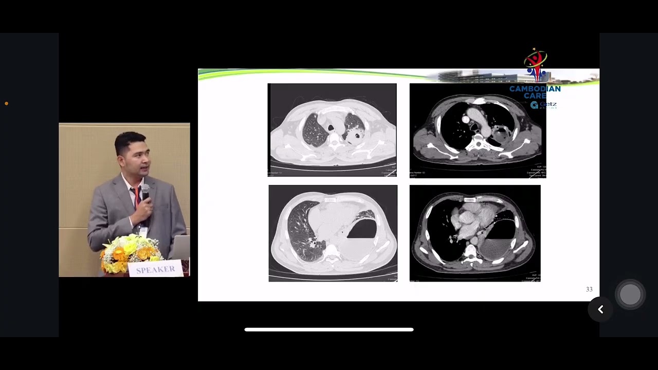 Management of lung abscess - YouTube