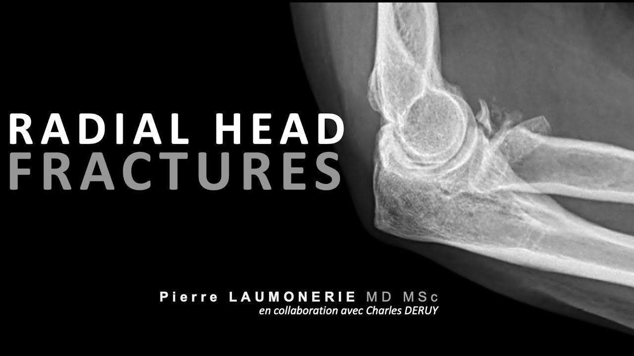Fractures de la tête radiale (Radial head fracture) - YouTube