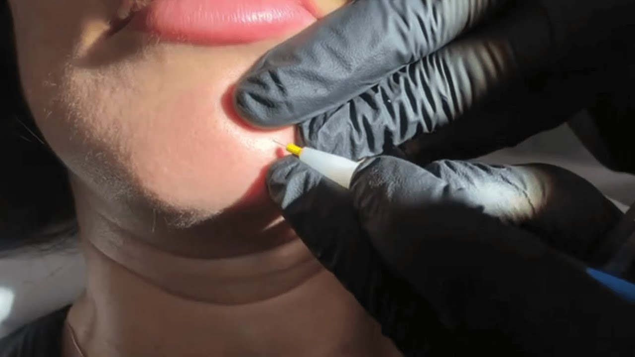 Electrolysis Session - YouTube