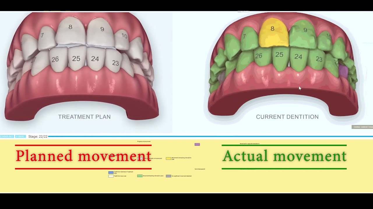 #Invisalign Progress Assessment Tool in ORTHODONTICS. iTero Element ...