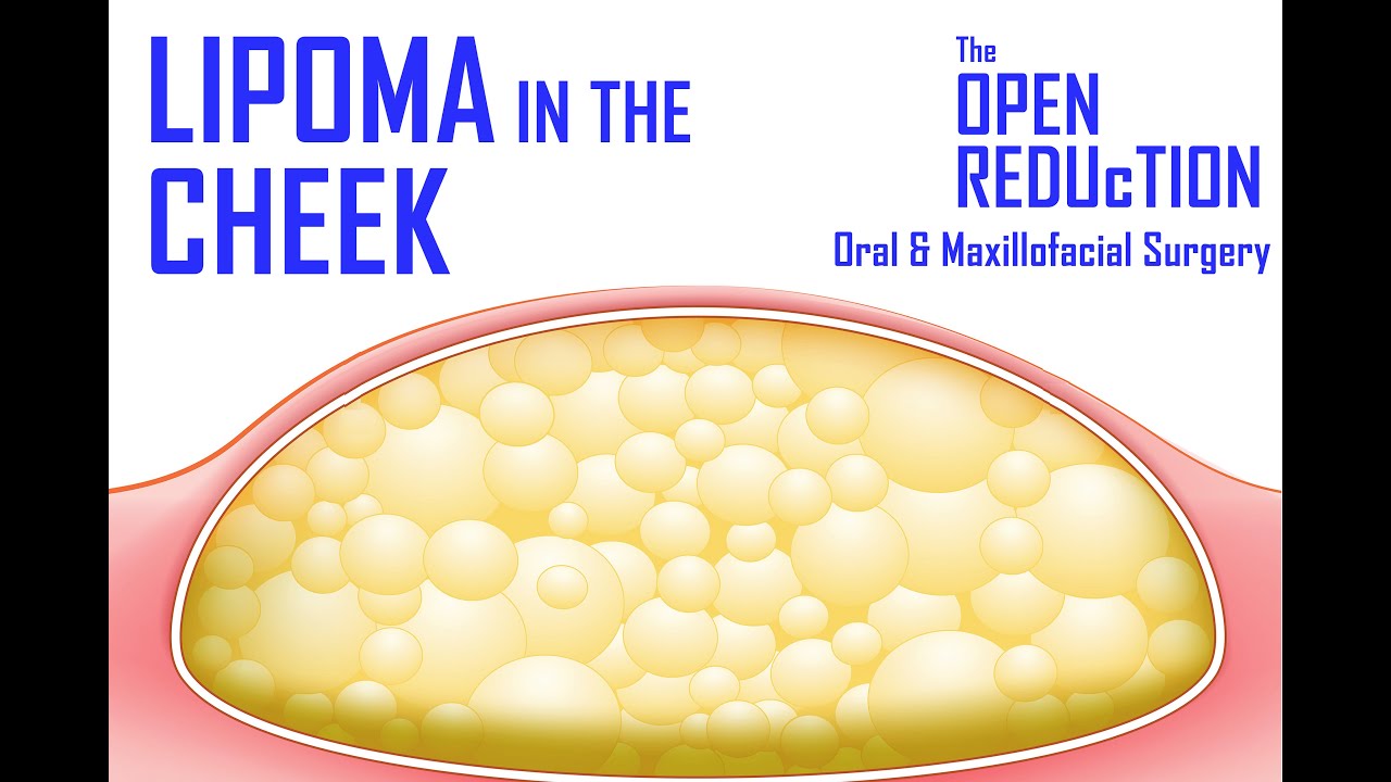 LIPOMA in the CHEEK - YouTube