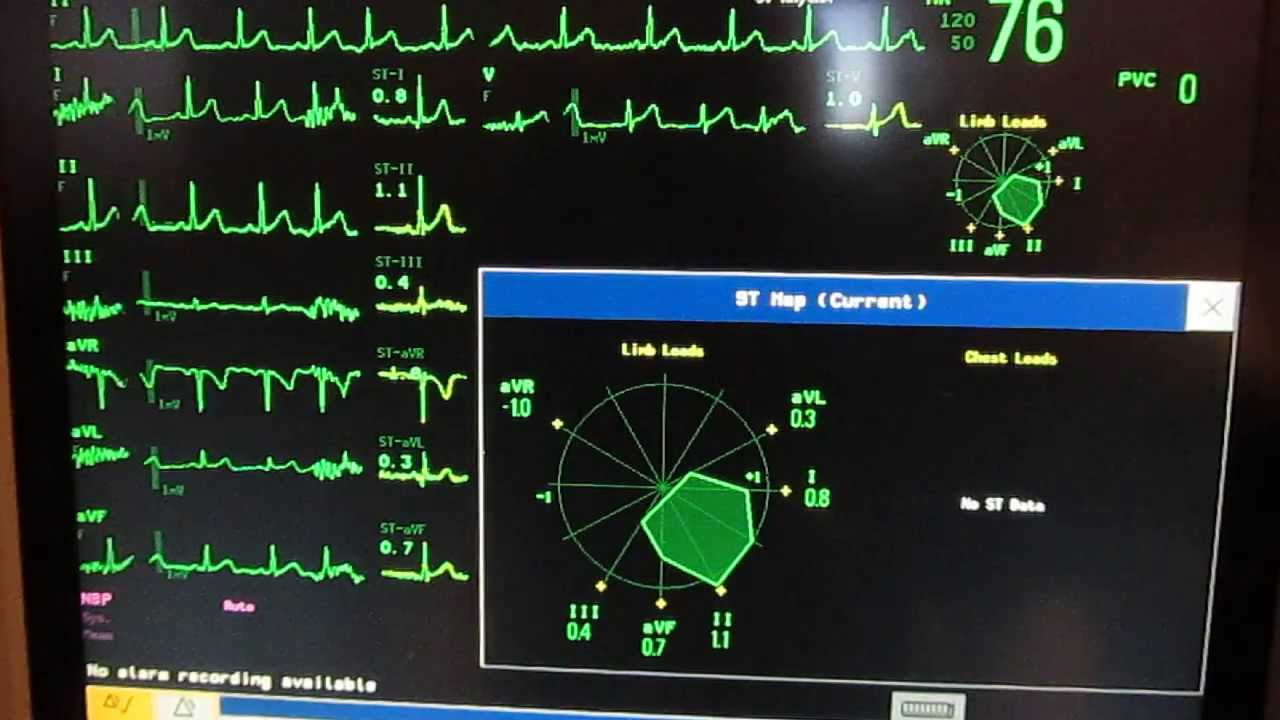 IntelliVue ST Map +multiple ECG - YouTube