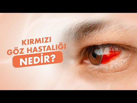 Kırmızı Göz Hastalığı Nedir? | Doç. Dr. Faruk Kaya