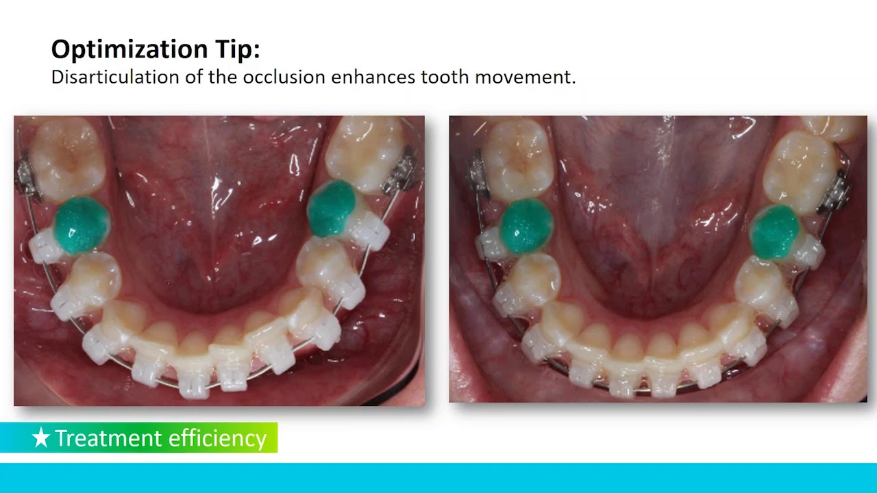 Engaging with Self-Ligation Achieving your goals with low force and ...