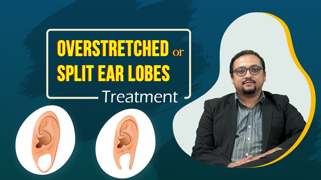 How to treat Stretched or split ear lobe due to heavy ear rings?-Dr ...